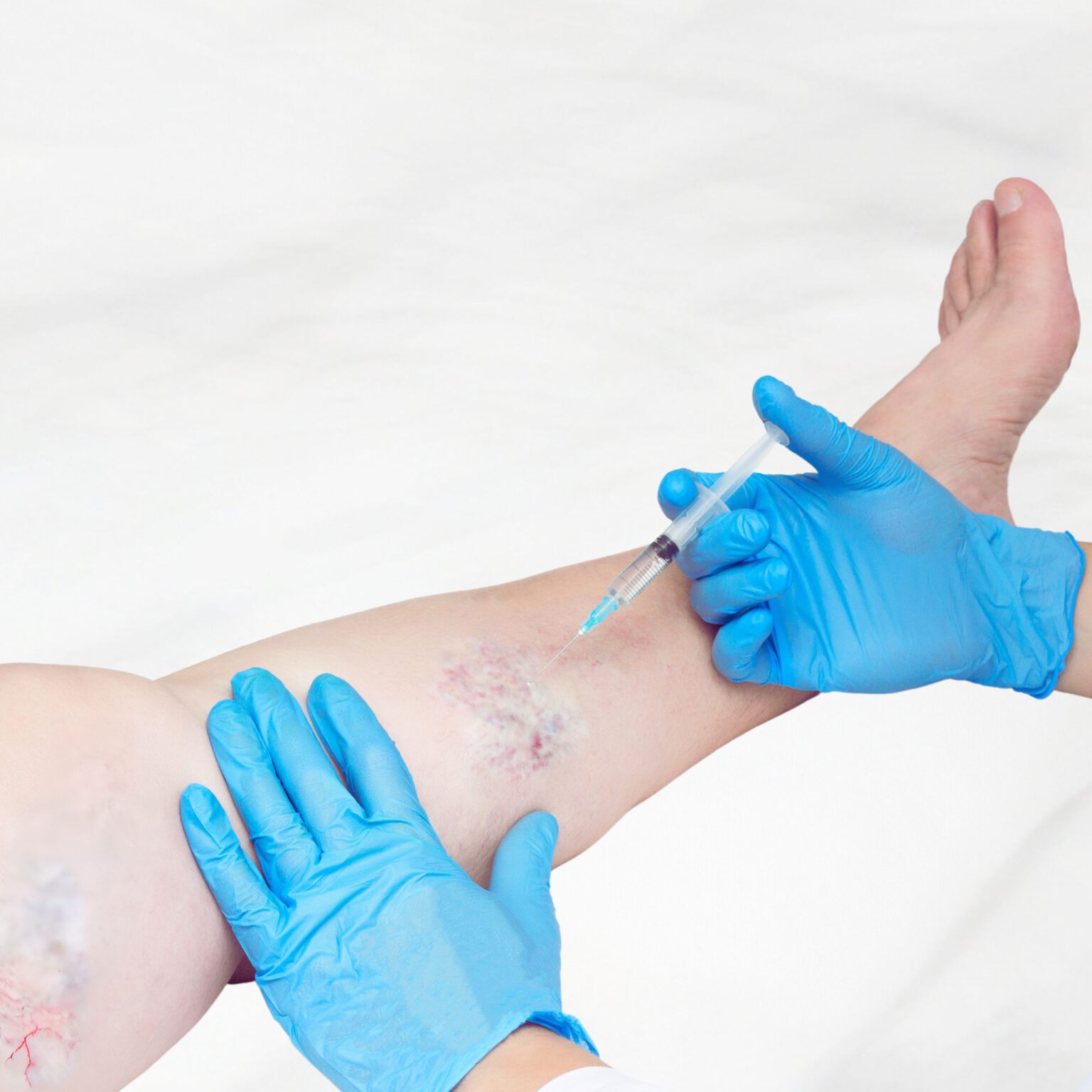 Besenreiserverödung – Dermatologie Plochingen