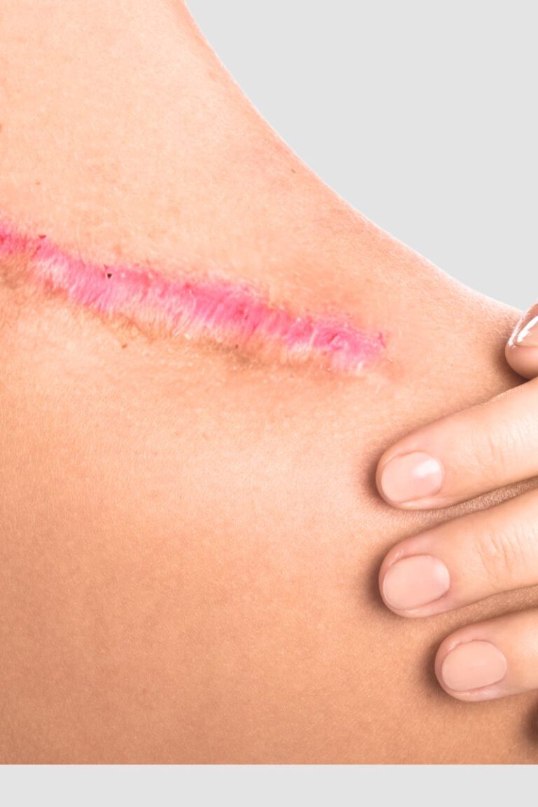 Narbenbehandlung – Dermatologie Plochingen